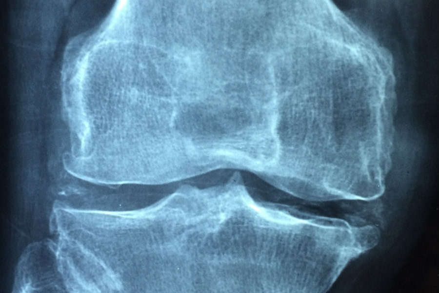 Arthrosurface Wave for Knee Joint Surface Defects in Knee Cap ...